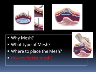 Prosthesis and fixation device | PPTX | Death, Injury, or Military ...