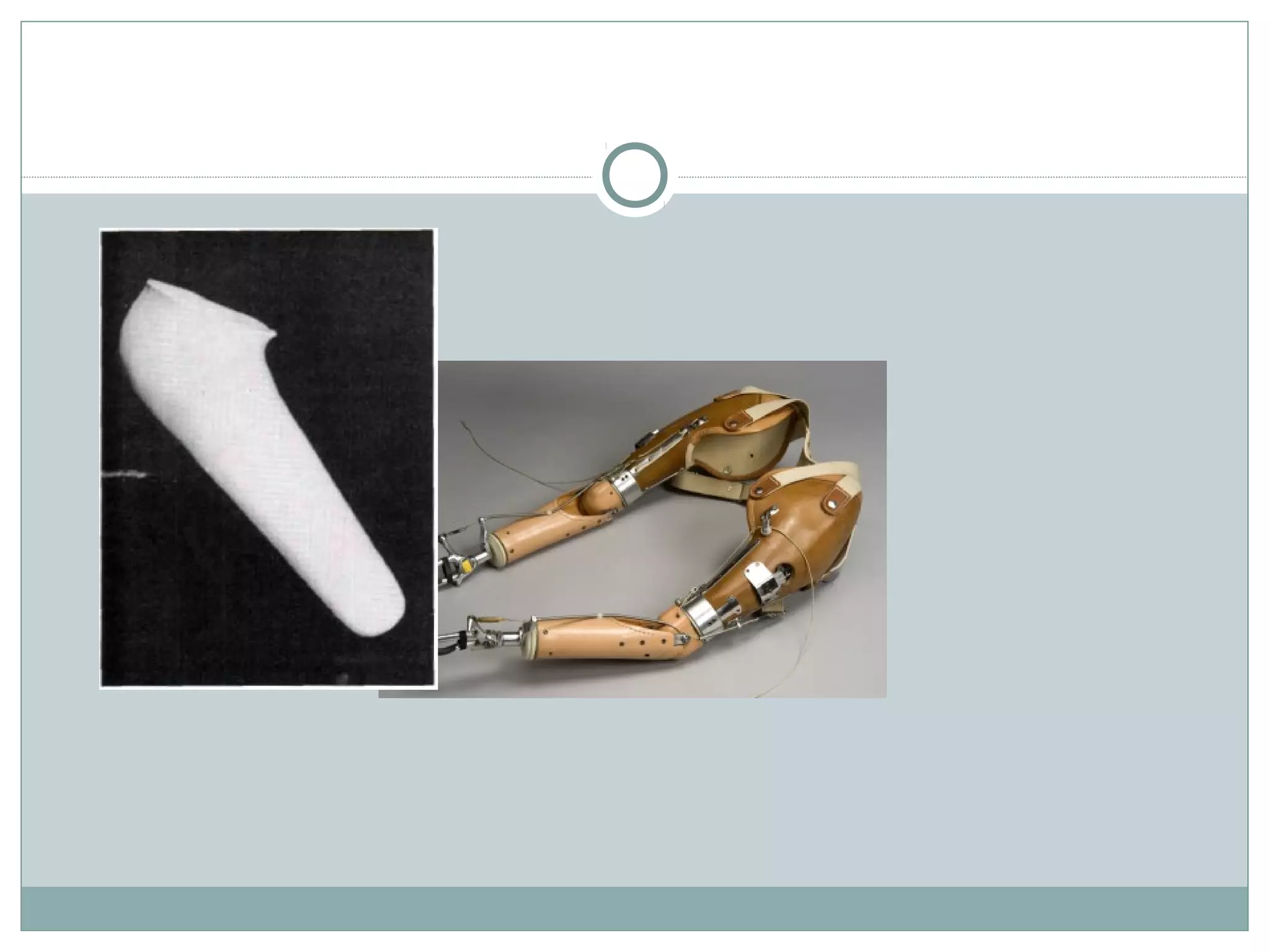 Prosthesis and orthotics | PPT