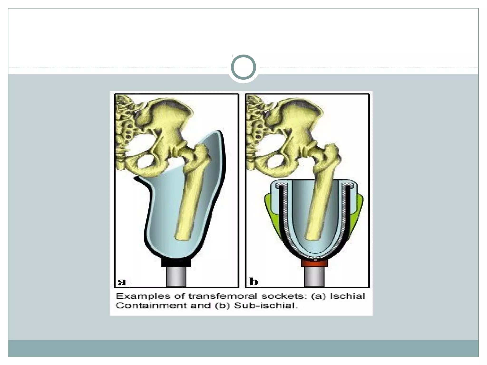 Prosthesis and orthotics | PPT