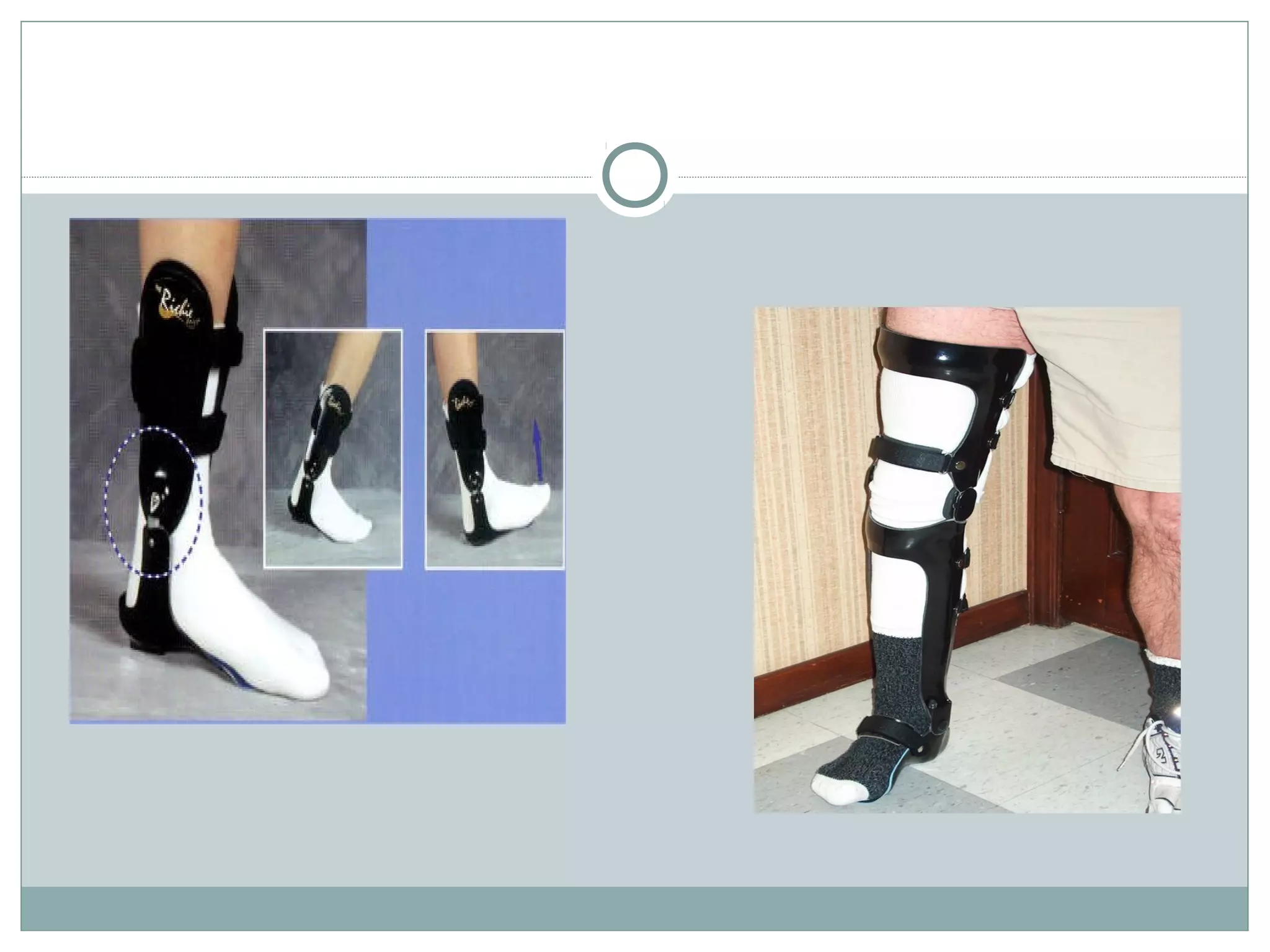 Prosthesis and orthotics | PPT