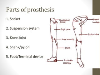 Lower Limbs Prosthesis | PPTX