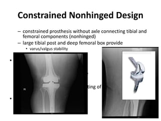 Prosthesis selection | PPTX