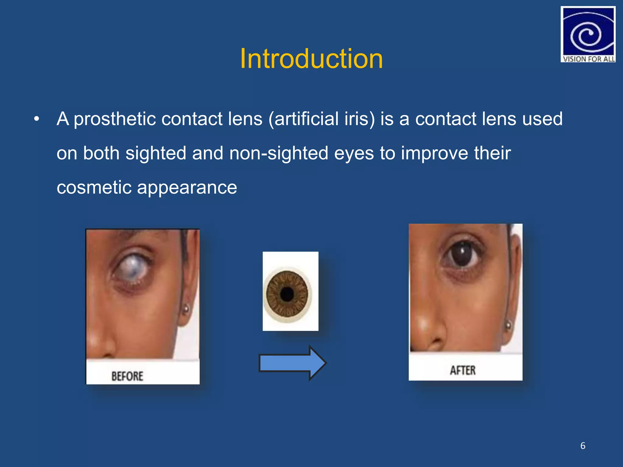 Prosthetic Contact Lens (Grand round) | PPTX