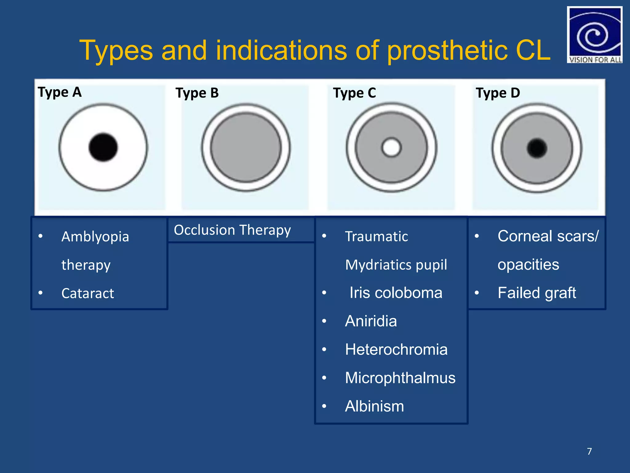 Prosthetic Contact Lens (Grand round) | PPTX
