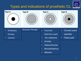 Prosthetic Contact Lens (Grand round) | PPTX