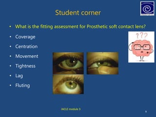Prosthetic Contact Lens (Grand round) | PPTX
