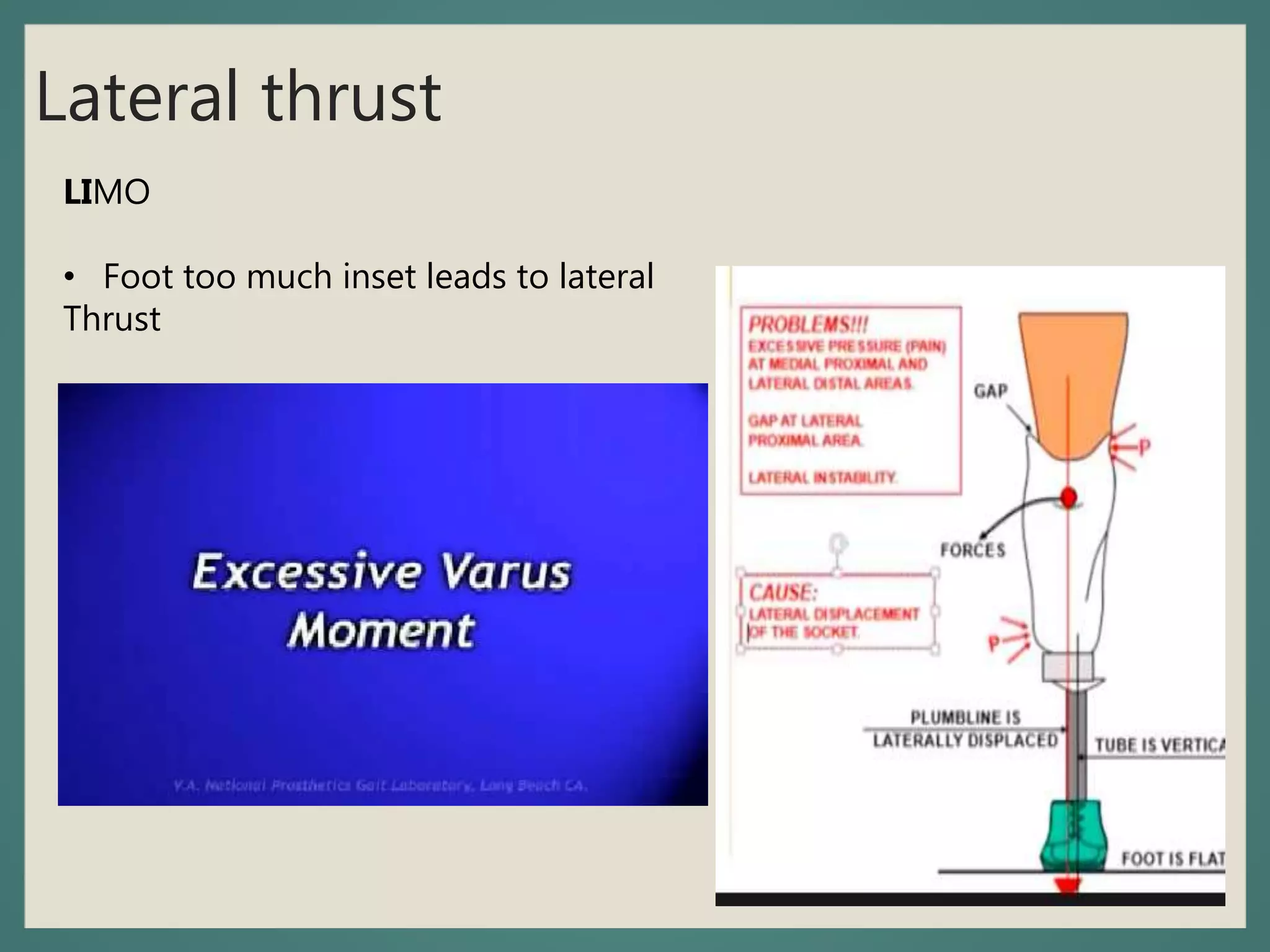 Prosthetic gait deviation | PPTX