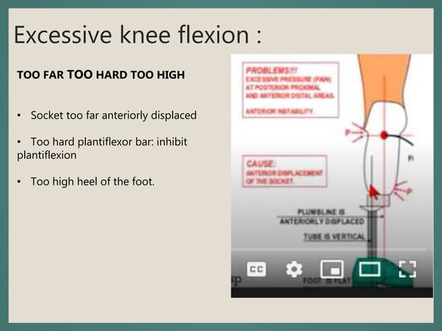 Prosthetic gait deviation | PPTX | Death, Injury, or Military Conflict ...