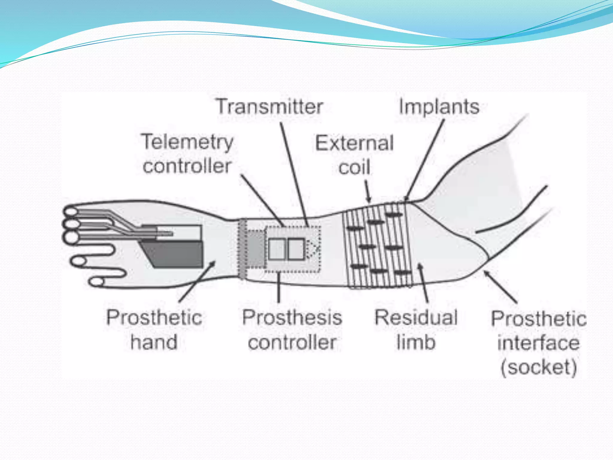 Prosthetic hand ppt | PPTX