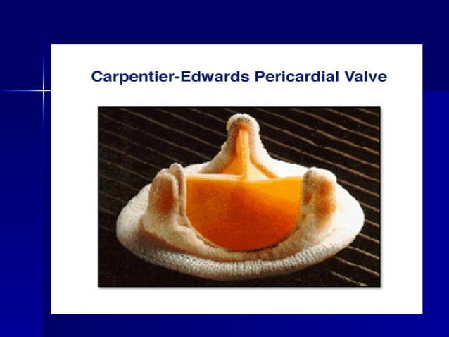 Prosthetic Heart Valves | PPT