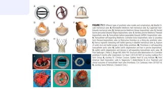Prosthetic Heart Valves from Research Paper | PPTX