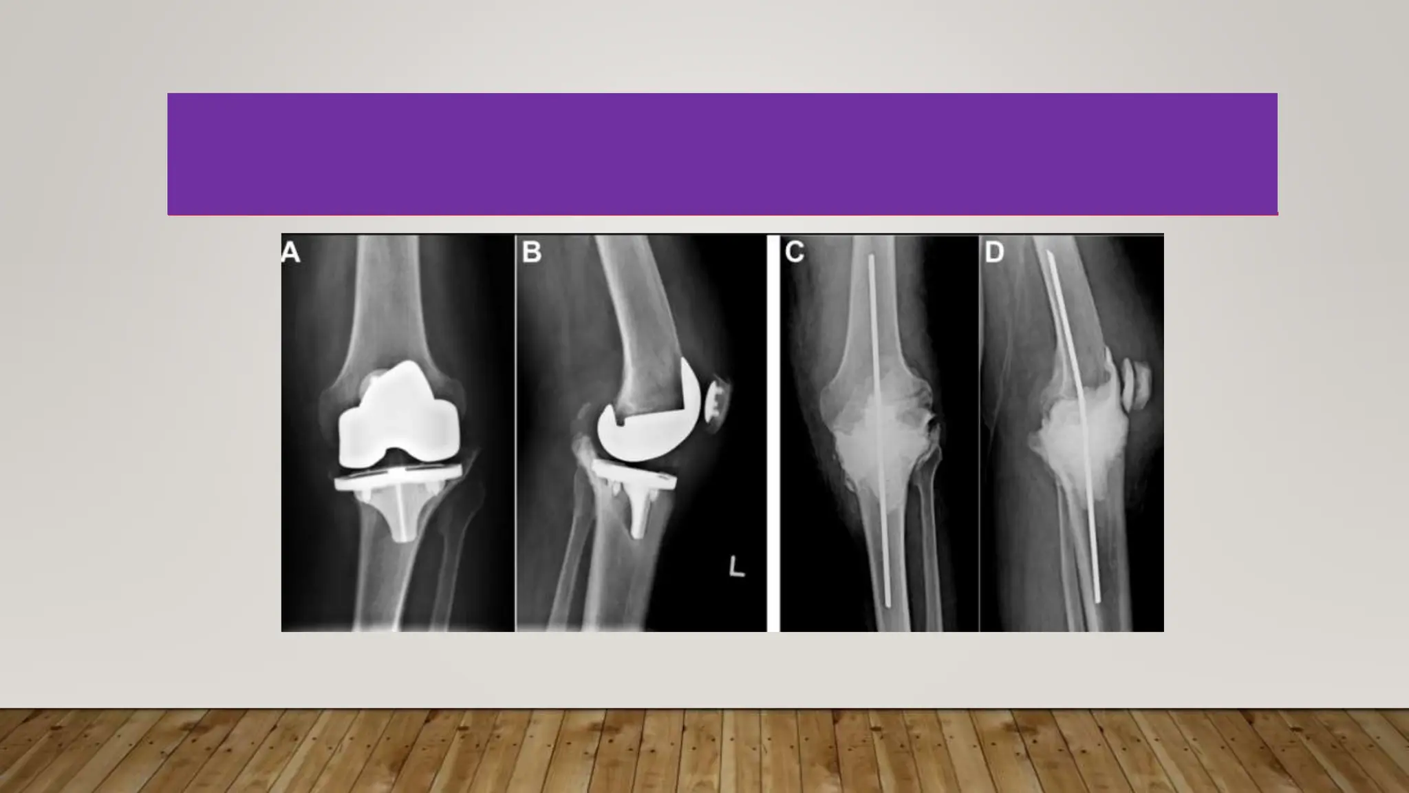 prosthetic joint infection(diagnosis and management ).pptx