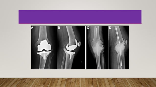 prosthetic joint infection(diagnosis and management ).pptx