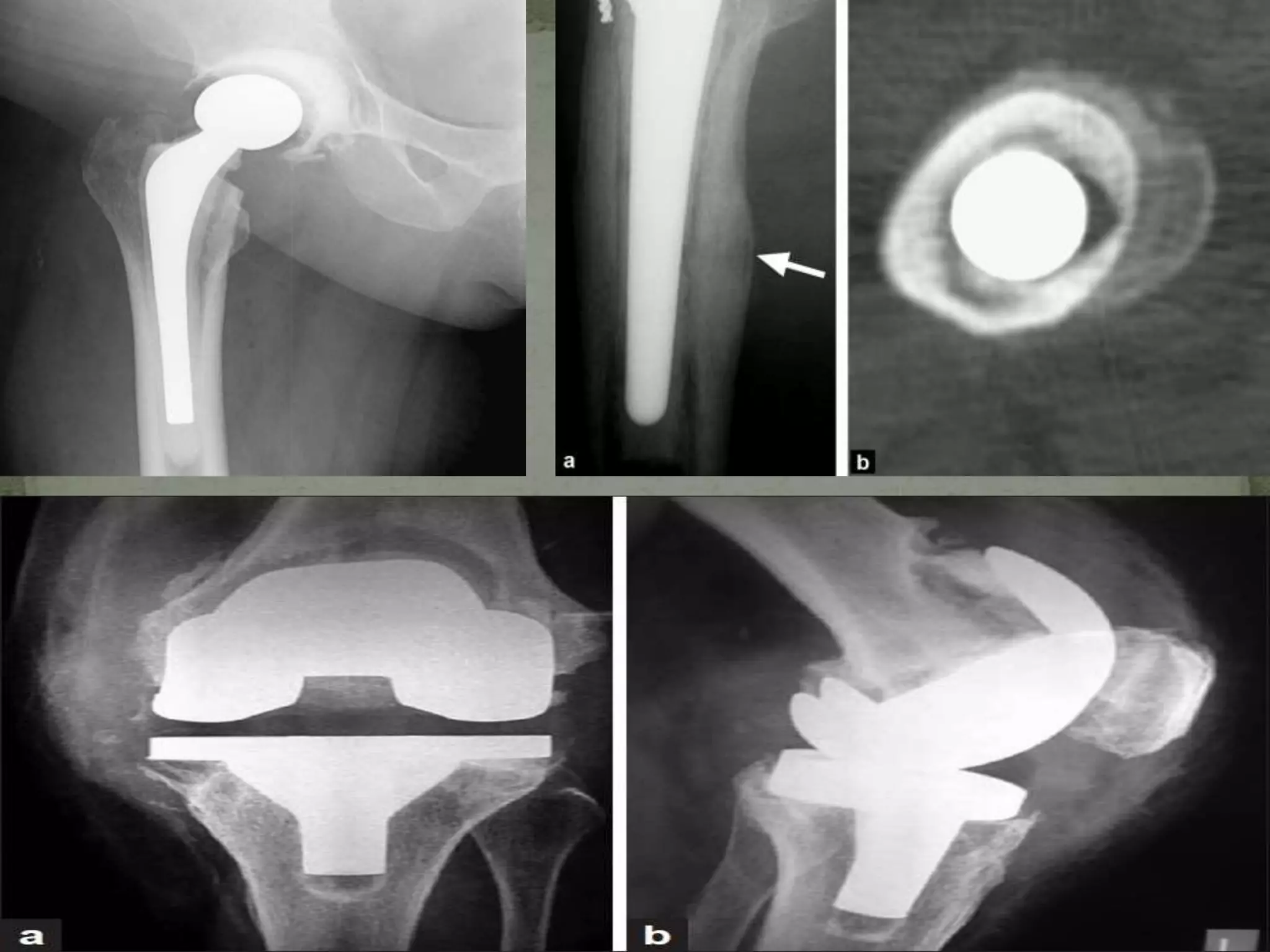 Prosthetic joint infections | PPTX