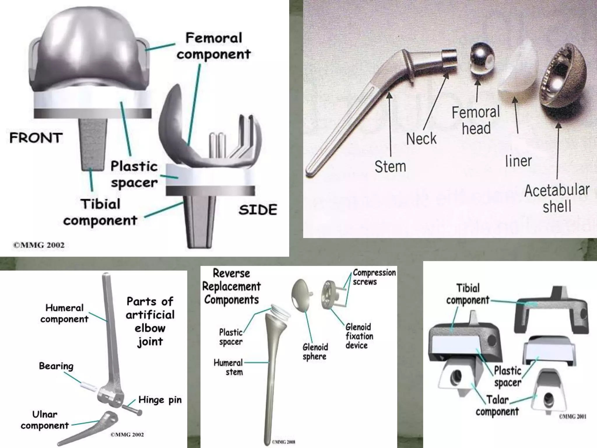 Prosthetic joint infections | PPTX