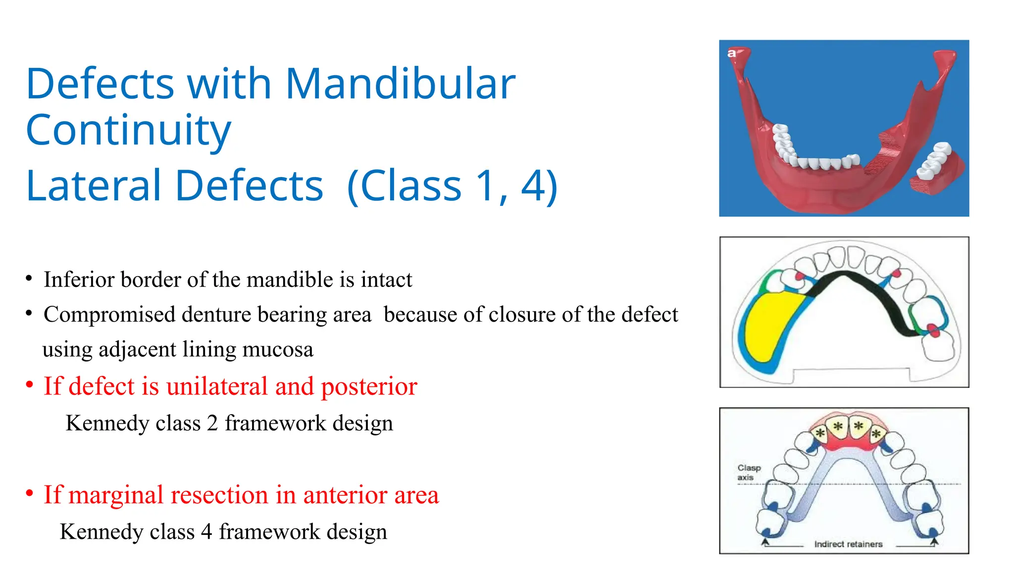 Prosthetic Management for Resected Mandible.pptx