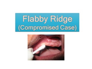 Prosthetic Management of Abused Tissues.ppt