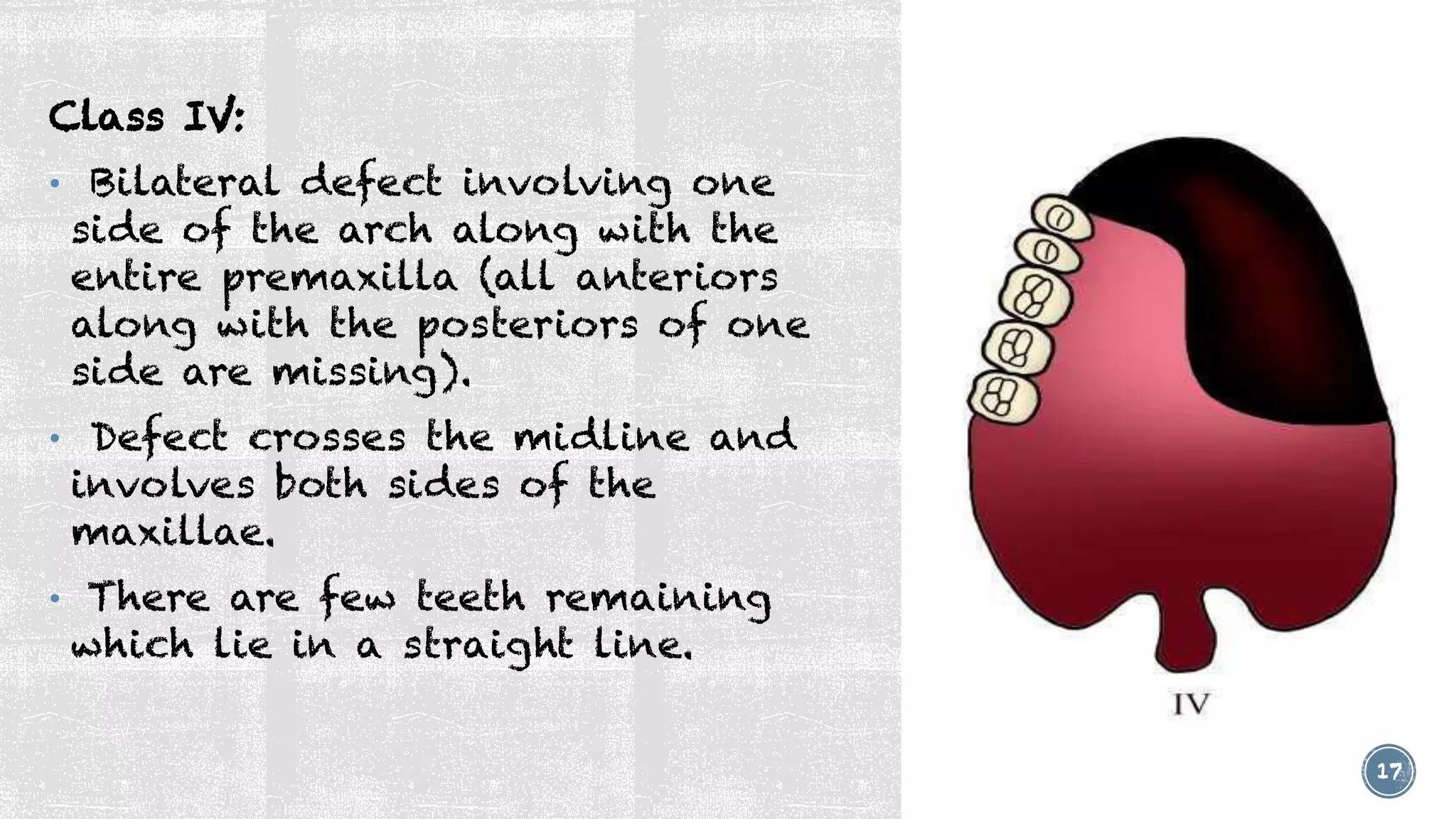 Prosthetic Management Of Acquired Maxillary Defects Ppt