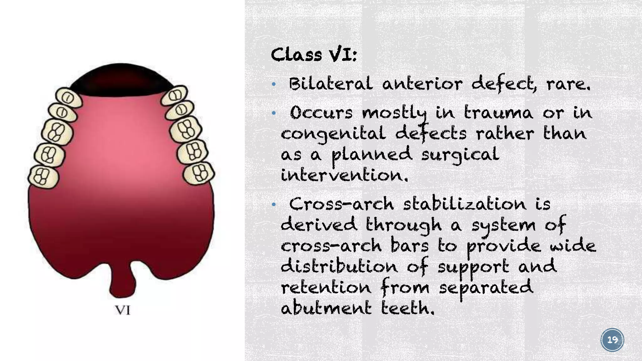 Prosthetic Management of Acquired Maxillary Defects | PDF