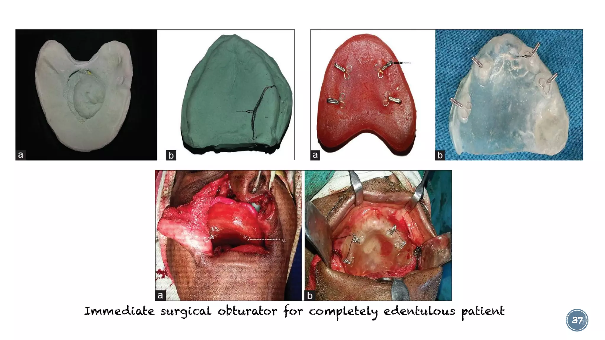 Prosthetic Management of Acquired Maxillary Defects | PDF
