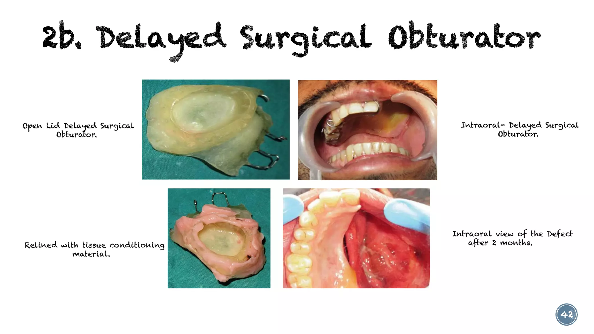 Prosthetic Management of Acquired Maxillary Defects | PDF