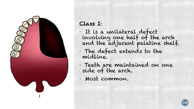 Prosthetic Management of Acquired Maxillary Defects | PDF | Ear, Nose ...
