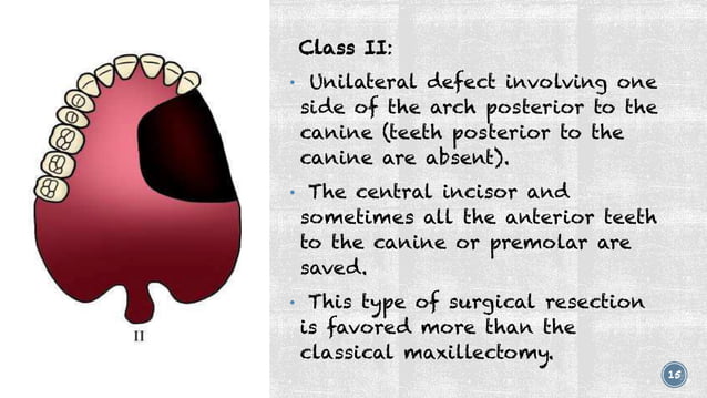 Prosthetic Management of Acquired Maxillary Defects | PDF | Ear, Nose ...
