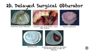 Prosthetic Management of Acquired Maxillary Defects | PDF