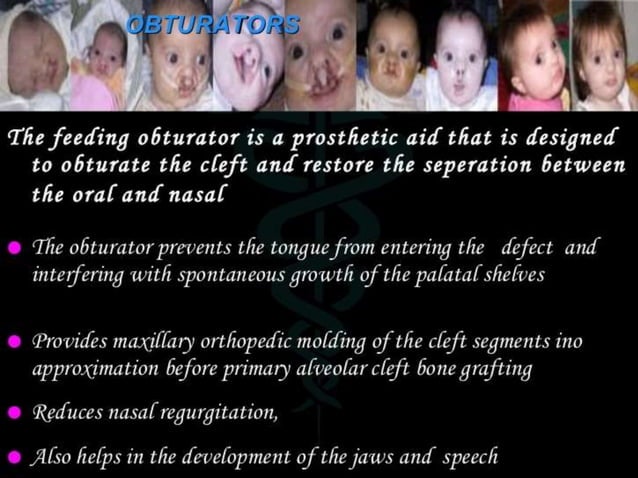 Prosthetic management of cleft lip and palate patient | PPTX | Dental ...