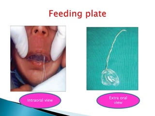 Prosthetic management of cleft lip and palate patient | PPTX