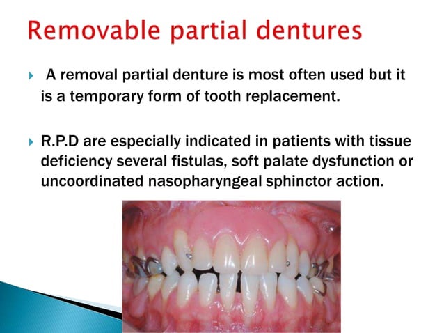 Prosthetic management of cleft lip and palate patient | PPTX