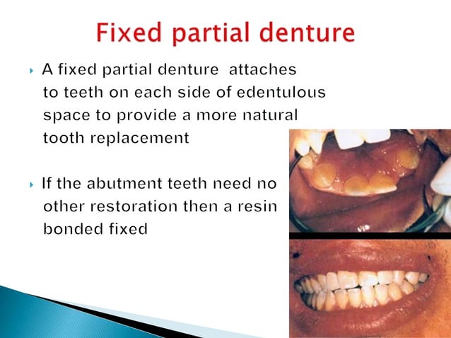 Prosthetic management of cleft lip and palate patient | PPTX | Dental ...