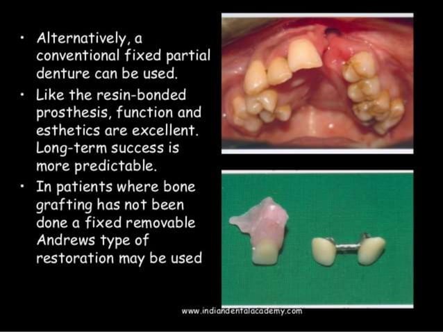 Prosthetic management of cleft lip and palate patient | PPTX | Dental ...