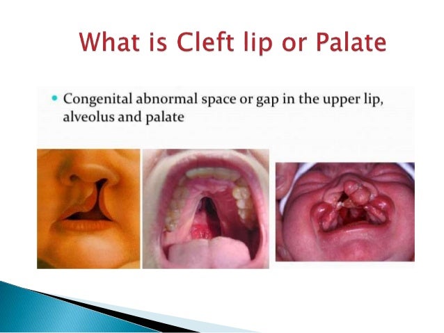 Prosthetic management of cleft lip and palate patient
