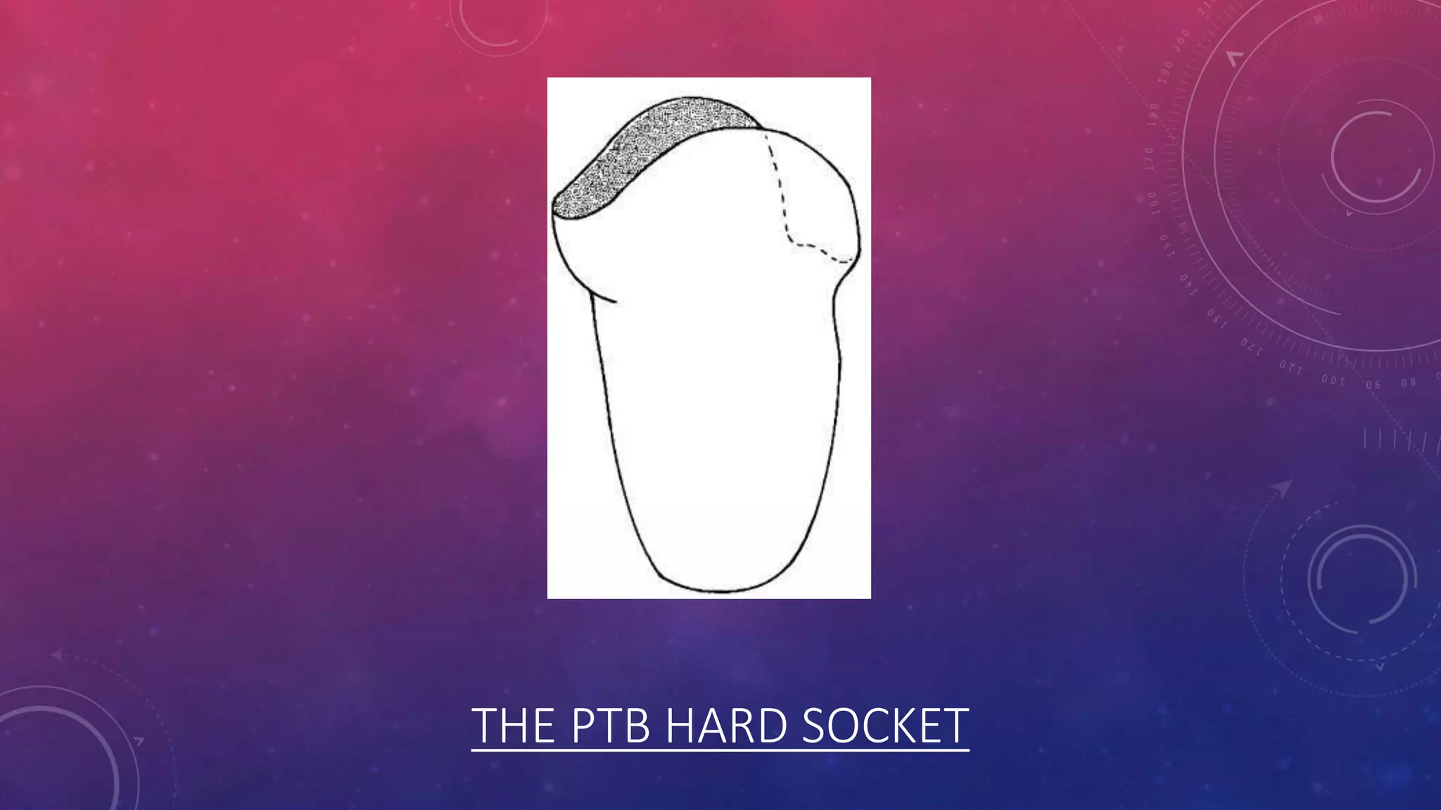 Prosthetic management of different levels of amputation | PPTX