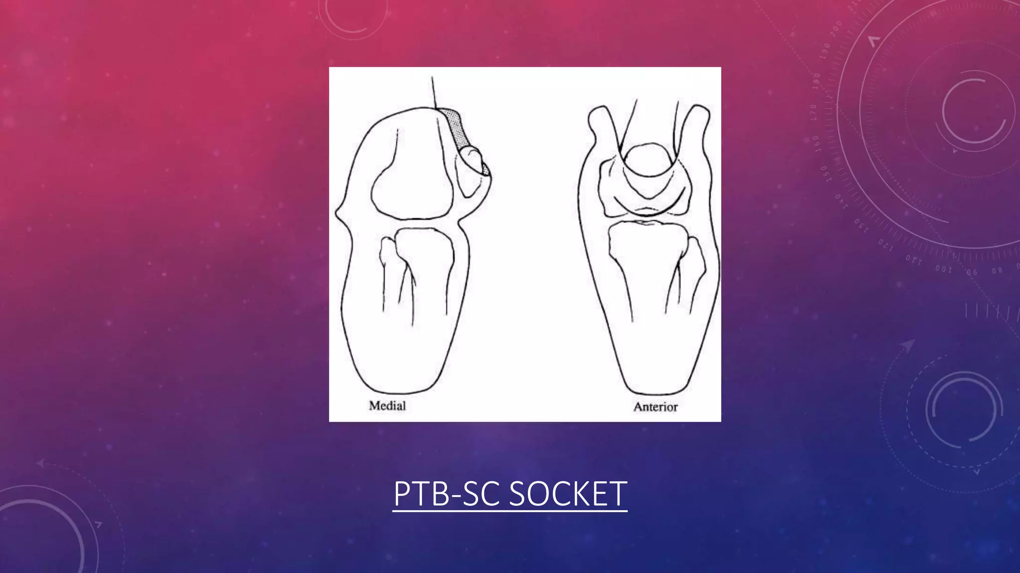 Prosthetic management of different levels of amputation | PPTX