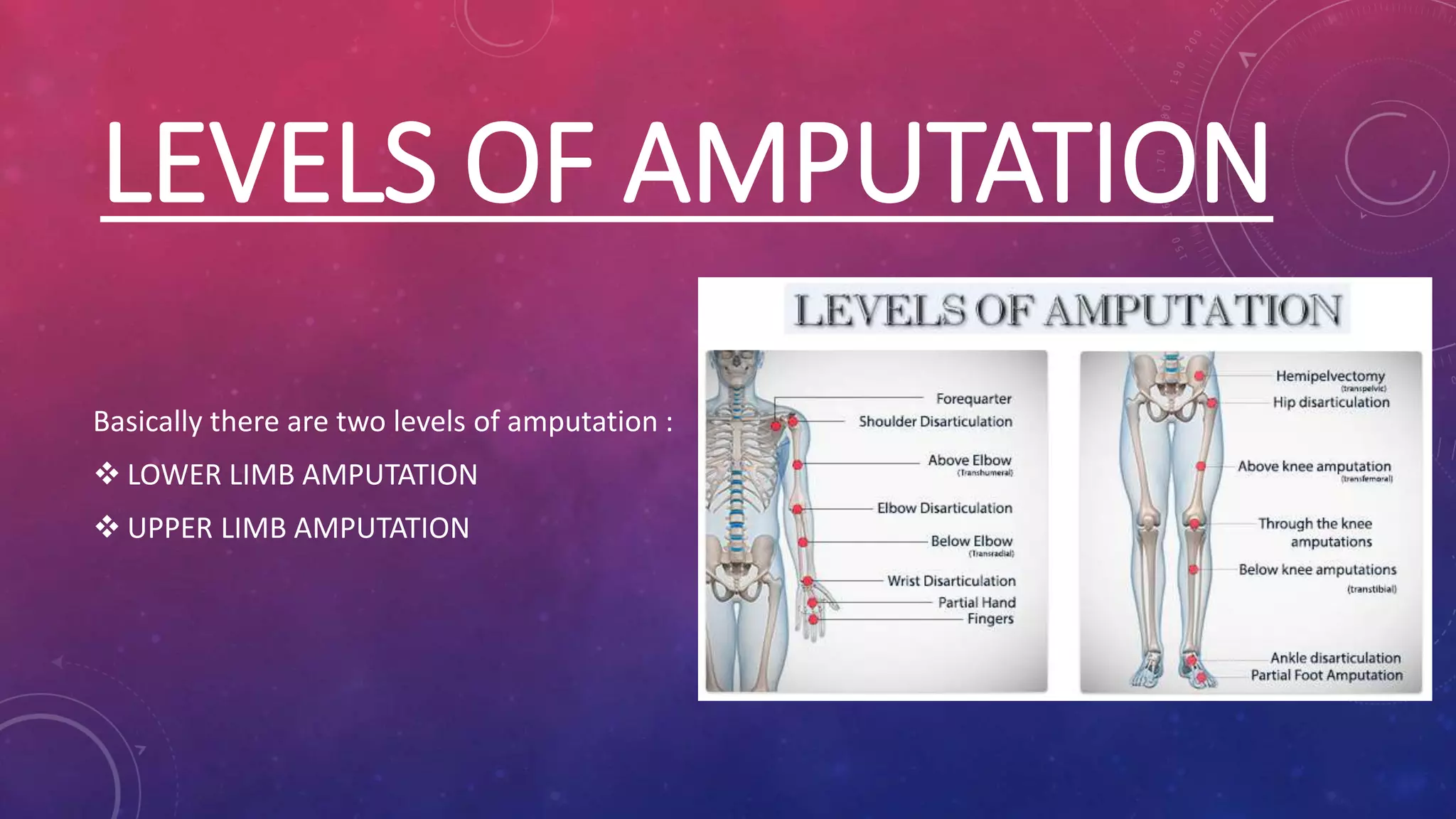 Prosthetic management of different levels of amputation | PPTX