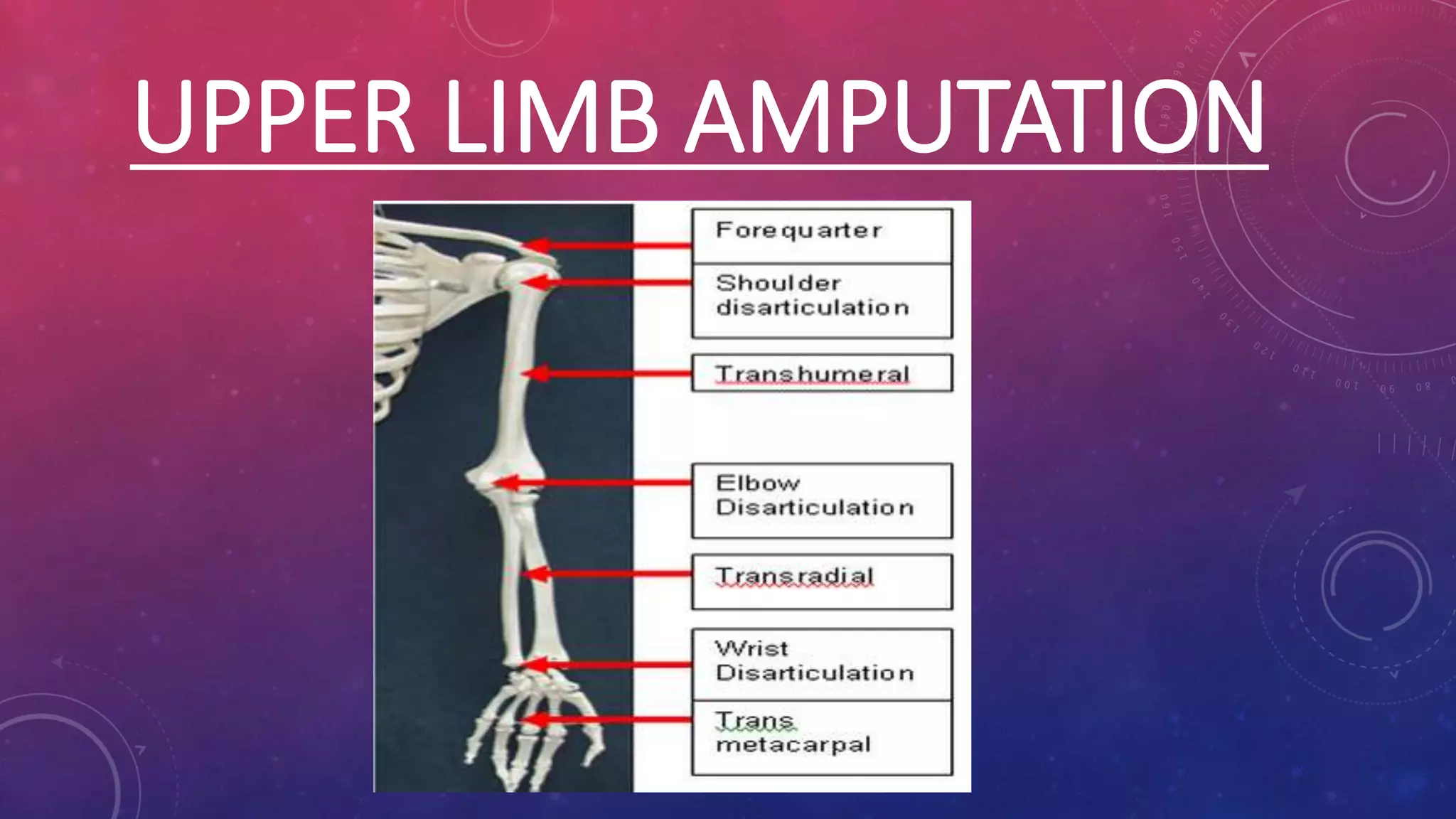 Prosthetic management of different levels of amputation | PPTX