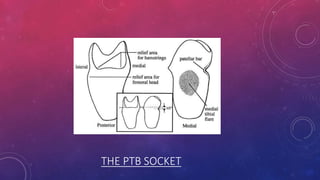 Prosthetic management of different levels of amputation | PPTX
