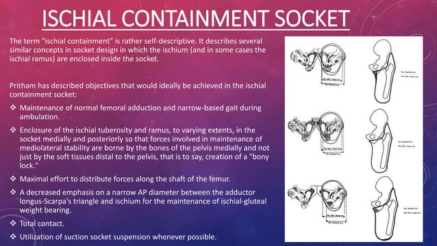 Prosthetic management of different levels of amputation | PPTX