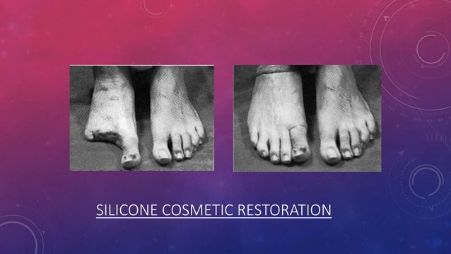 Prosthetic management of different levels of amputation | PPTX
