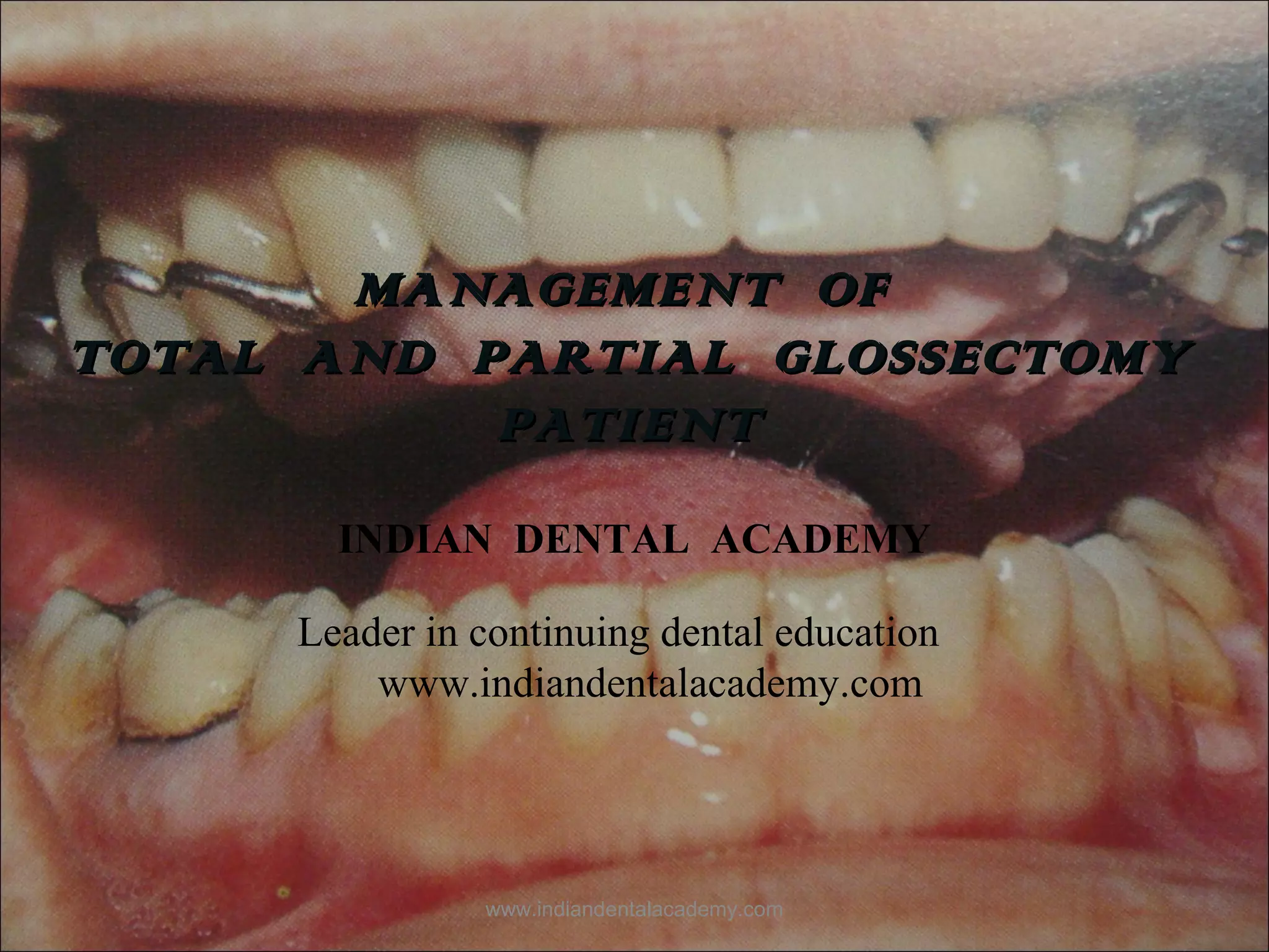 Prosthetic management of glossectomy/ orthodontic continuing education ...