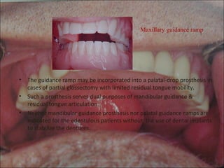 Prosthetic management of glossectomy/ orthodontic continuing education ...