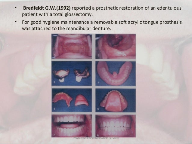 Prosthetic management of glossectomy/ orthodontic continuing education