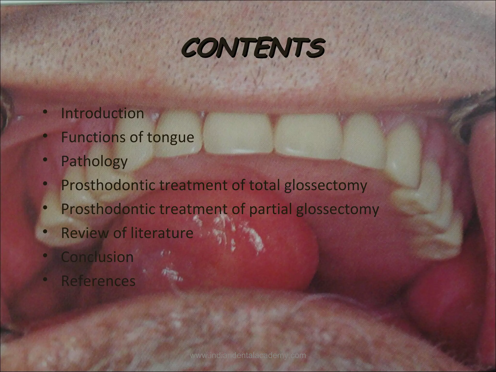 Prosthetic management of glossectomy/cosmetic dentistry courses | PPT