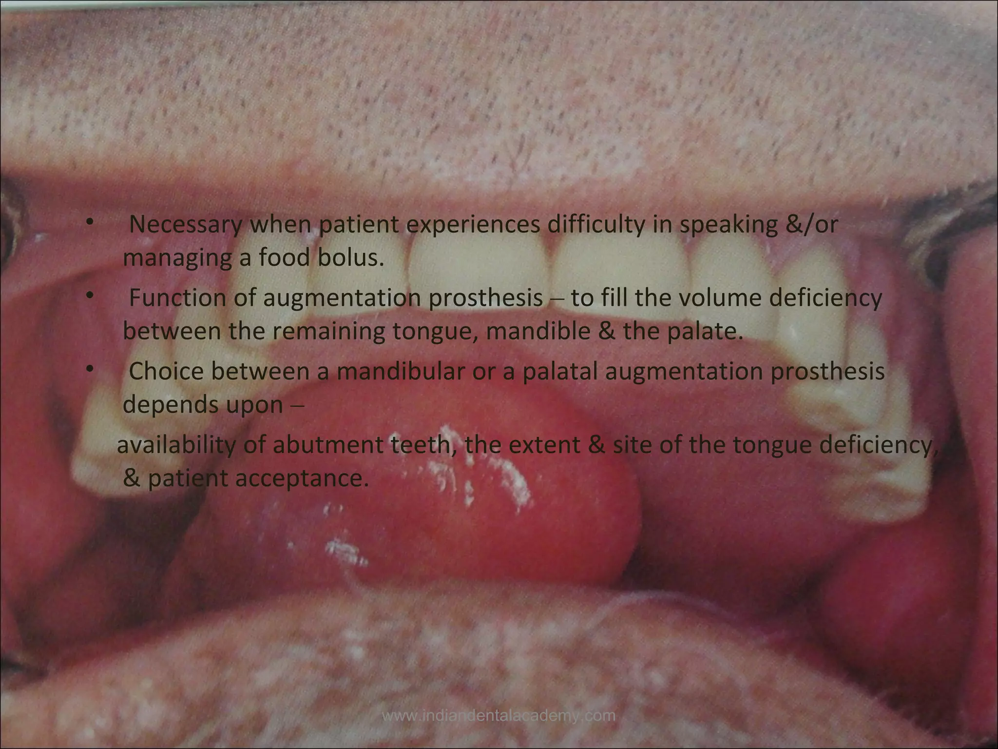 Prosthetic management of glossectomy/cosmetic dentistry courses | PPT
