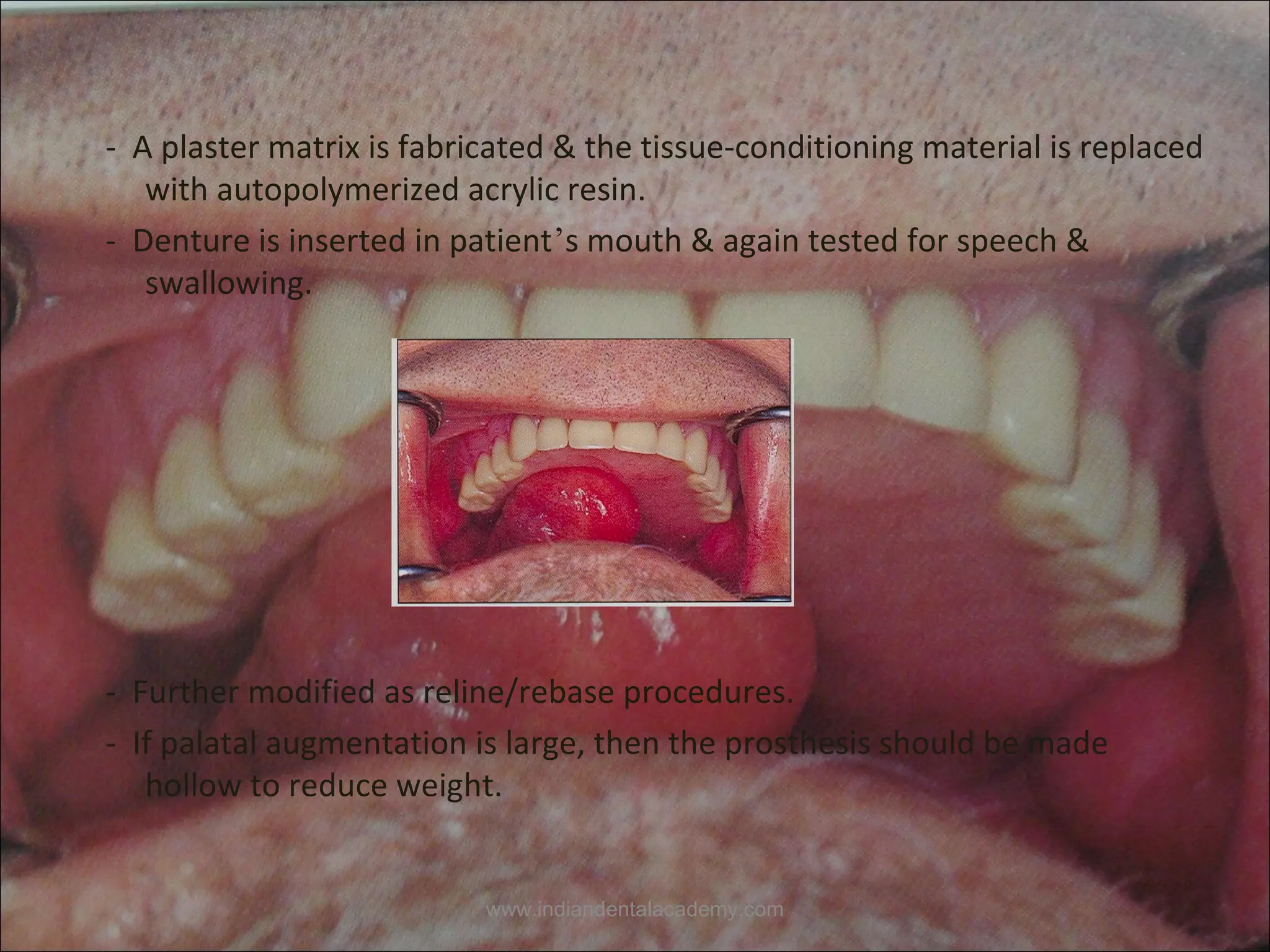 Prosthetic management of glossectomy/cosmetic dentistry courses | PPT