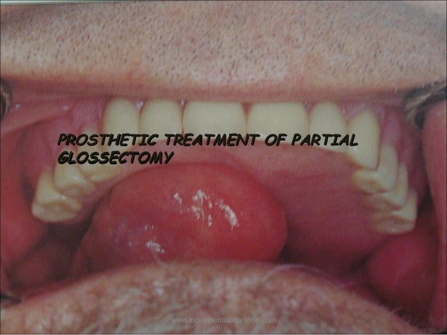 Prosthetic management of glossectomy/cosmetic dentistry courses