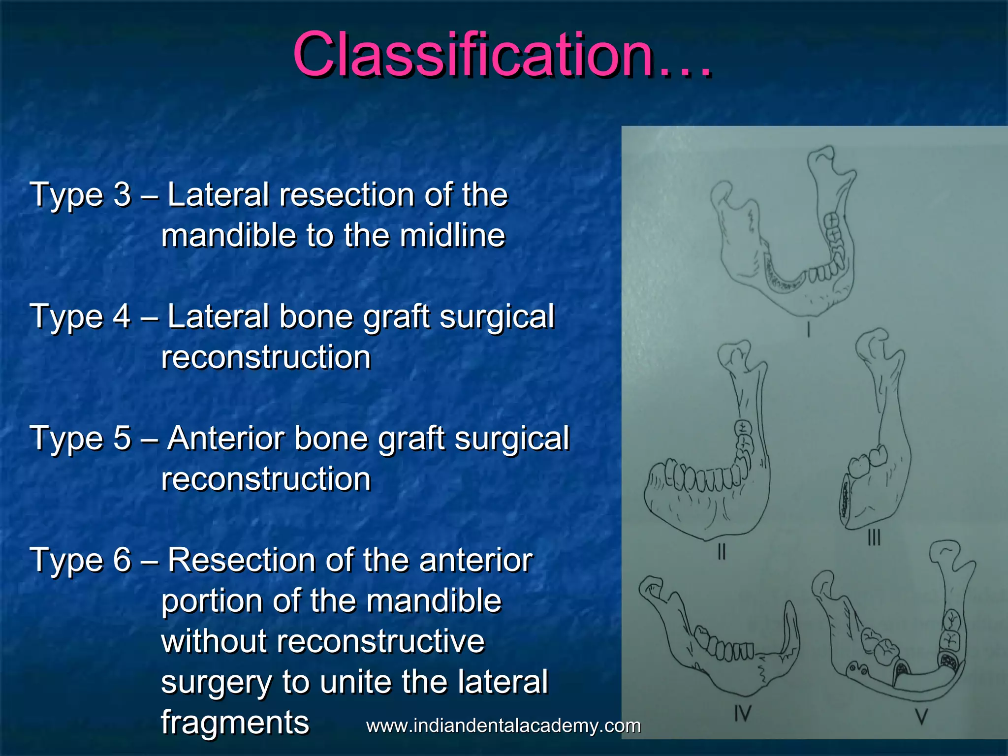 Prosthetic management of mandibulectomy and glossectomy pati ...