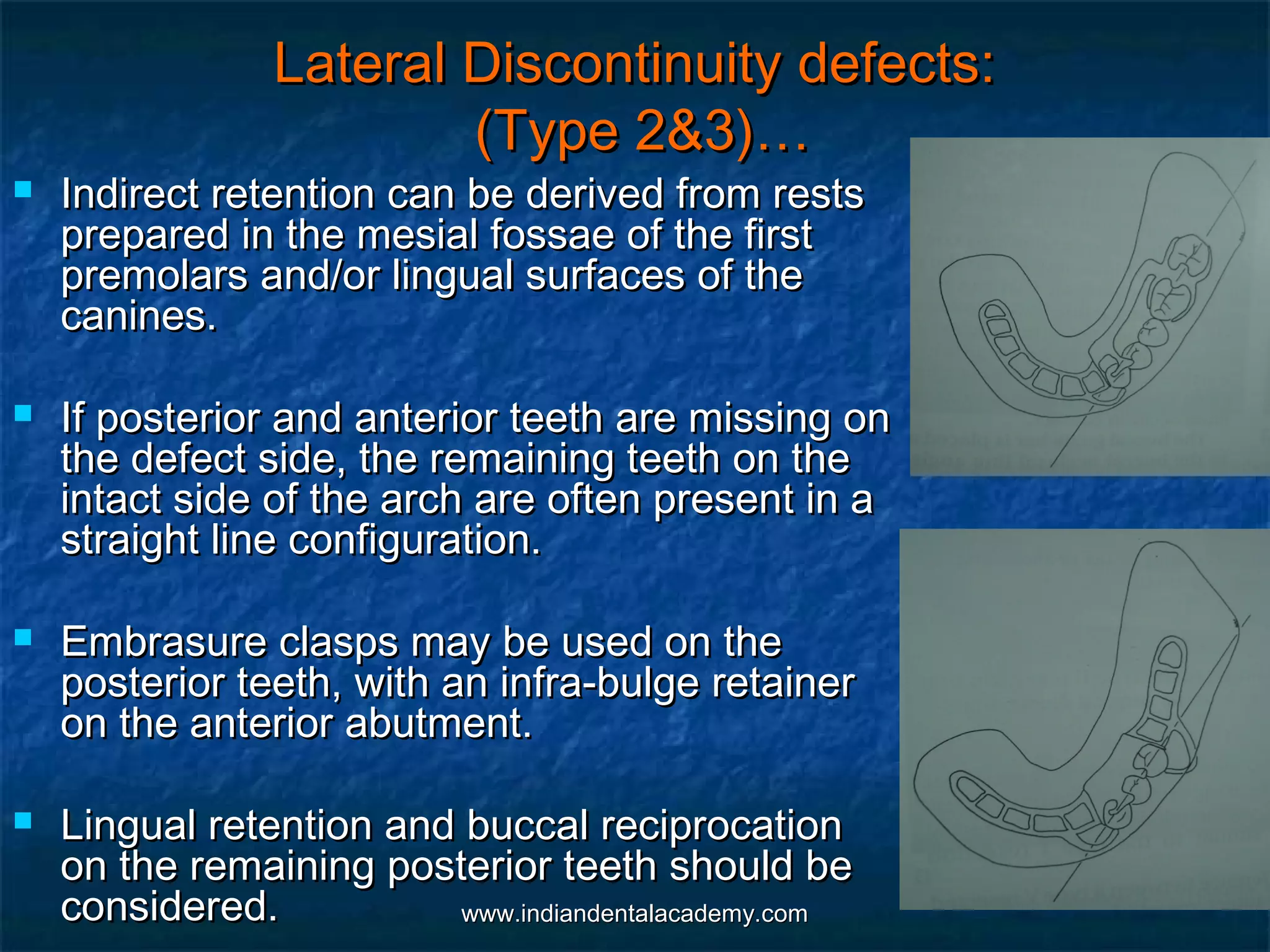 Prosthetic management of mandibulectomy and glossectomy pati ...